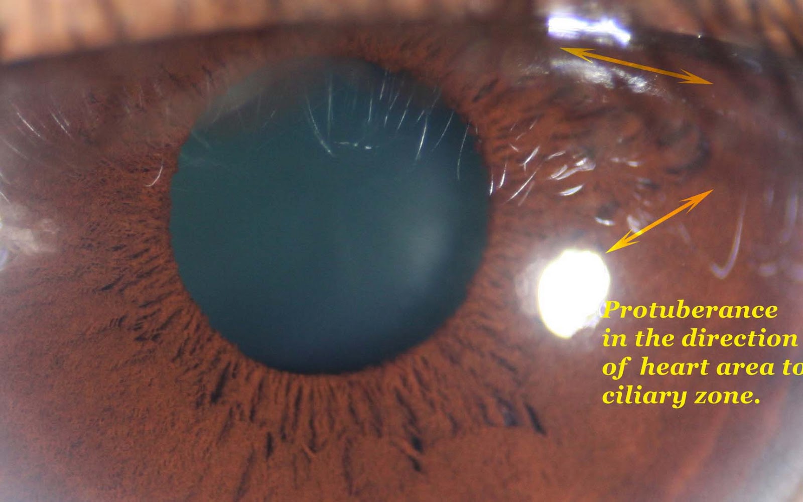 Modern & Multidimensional Iridology: Protuberance /Honeycomb /Romheld ...