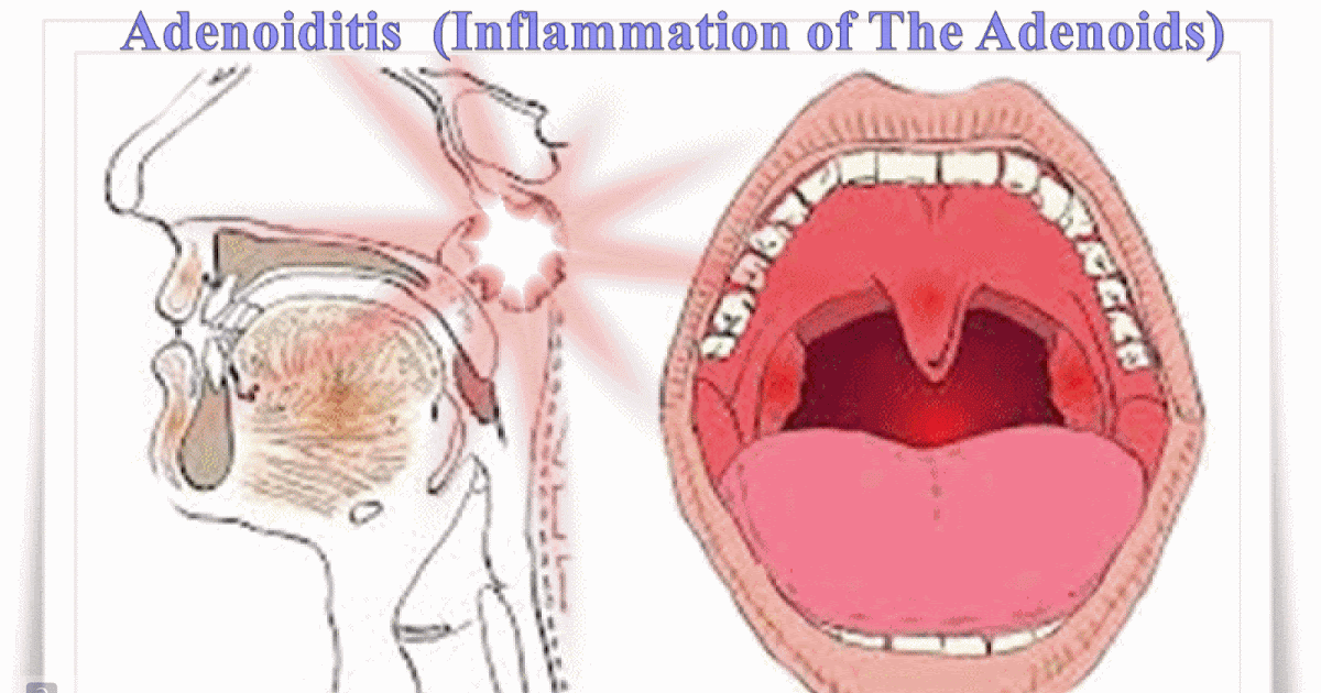 Adenoid Grommets at Randy Eubanks blog