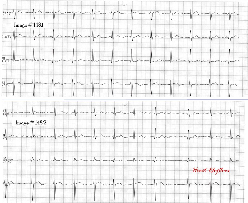 ECG Rhythms: The Lewis Lead: A lead placement to see oscillations