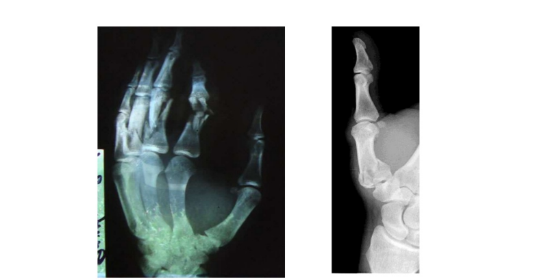 Fracturas de Muñeca y Mano