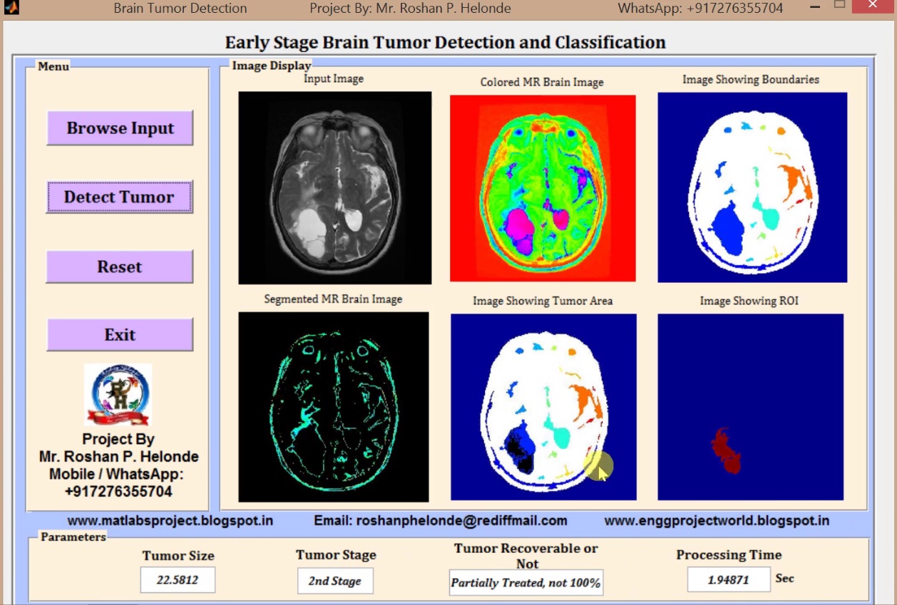 Early Stage Brain Tumor Detection Using Image Processing Matlab Project Code ~ Matlab Project Codes