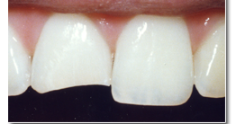 Tooth fragment reattachment