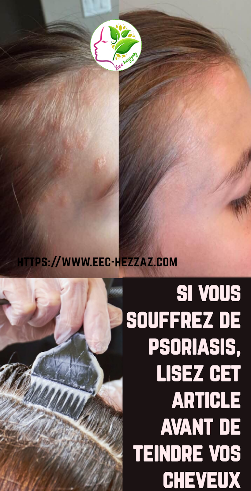 si vous souffrez de psoriasis, lisez cet article avant de teindre vos ...