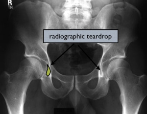 OsiriX HOW TO !: 第13回 OsiriXで股関節の計測！-（CE、Sharp）-
