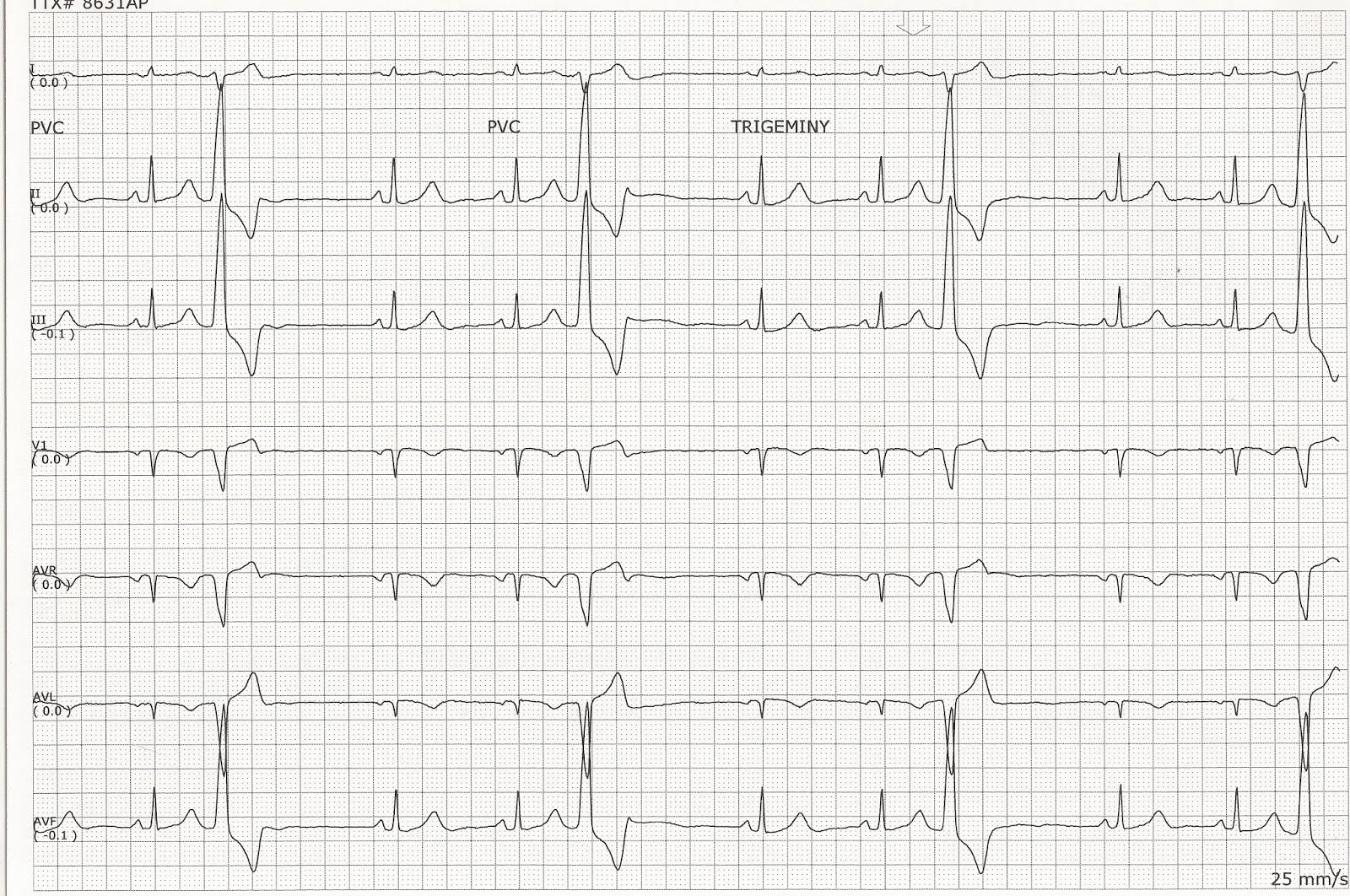 Trigeminal PVCs