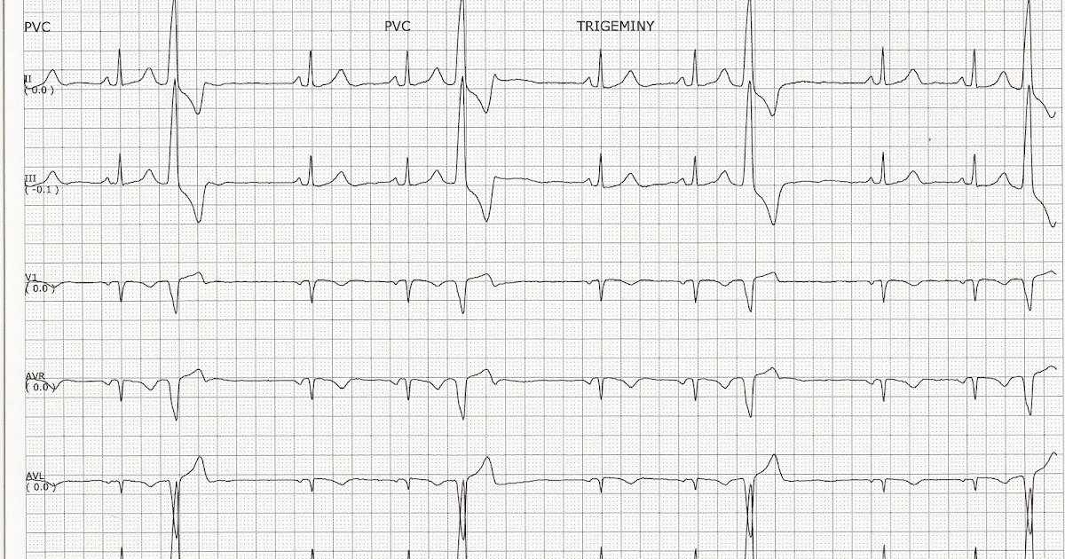 Trigeminal PVCs