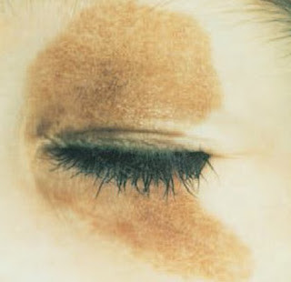 PUBLIC HEALTH: TUMOR MELANOCYTIC; Congenital Nevomelanocytic Nevus ...