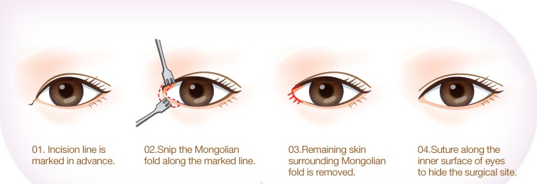 BK Plastic Surgery: [BK Plastic Surgery] Eyelid surgery-Inner corner ...