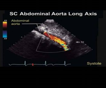 CVT Mohd Farid: Basic Echocardiography:Transthoracic Echocardiography Windows And Views