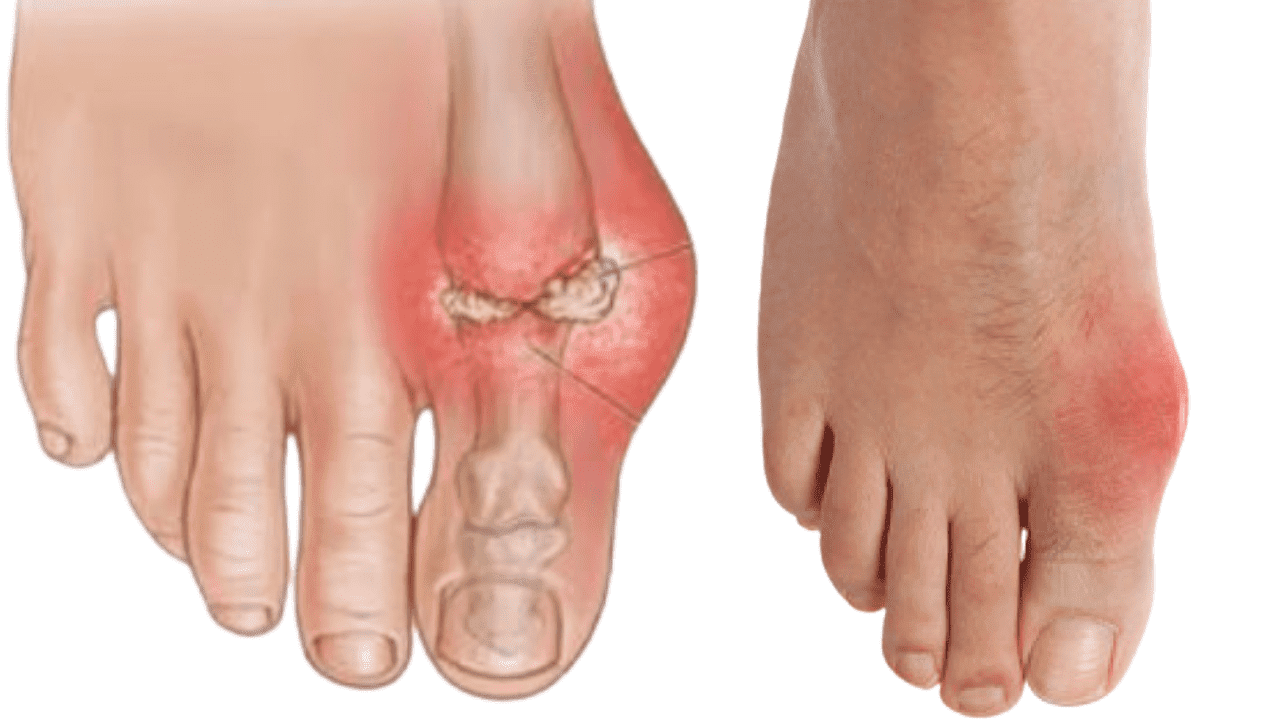 Qu’est-ce qu’une crise de goutte et comment la traiter, c’est quoi une ...