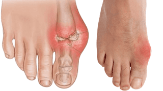 Qu'est-ce qui provoque la maladie de la goutte ? | Les principes de la ...