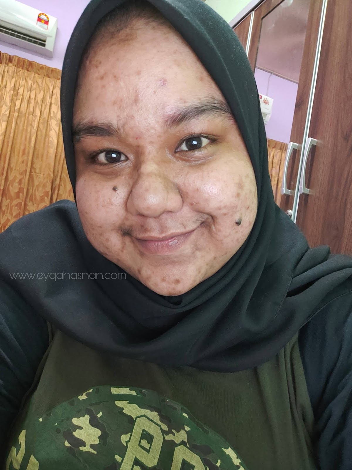 Kerana Local Skincare, Muka Aku Breakout