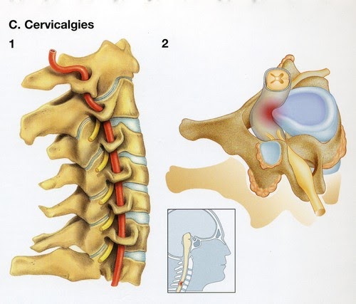 Blog 75: Infos santé : Kiné Ostéo-Arthrose cervicale