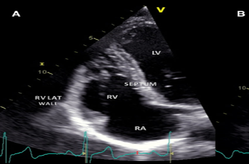 CVT Mohd Farid: Basic Echocardiography:Transthoracic Echocardiography ...