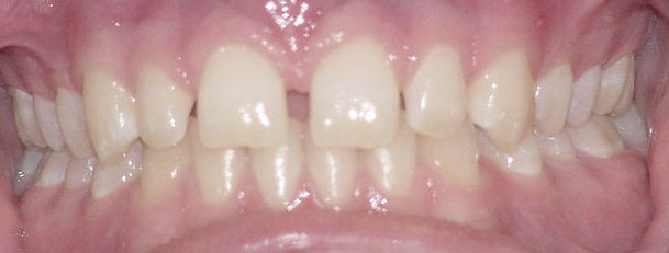 James R. Waters, DDS, MSD, PA: Crowded teeth can lead to early tooth loss.