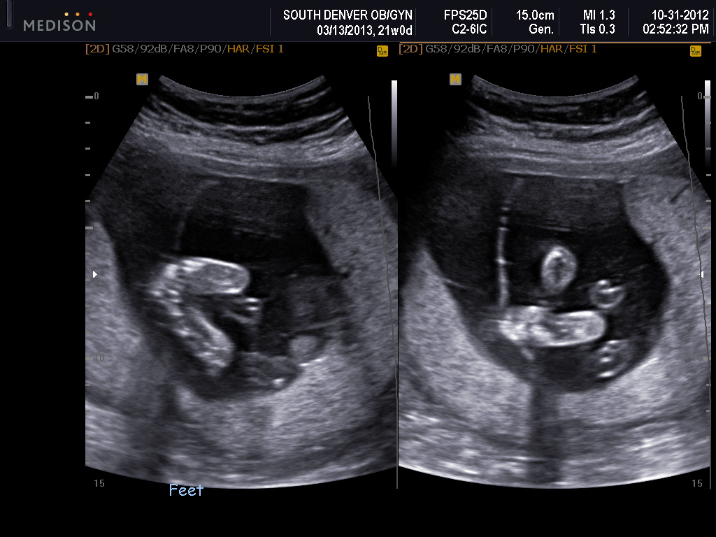 A Road Well Traveled: Anatomy Scan- 21 weeks!