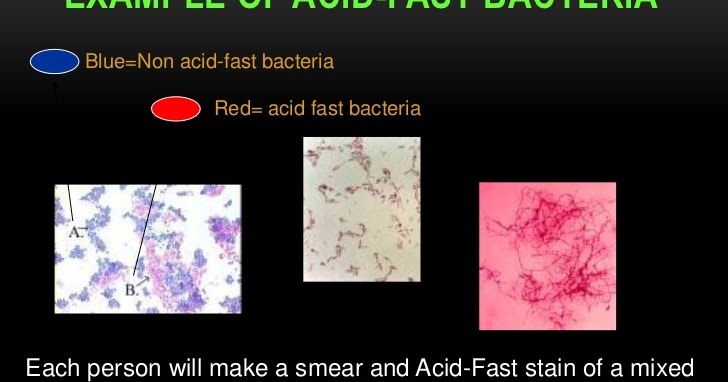 Acid fast bacteria (AFB)