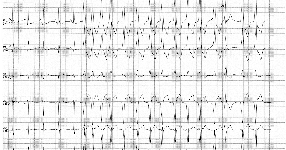 Sinus Rhythm with a Run of VT