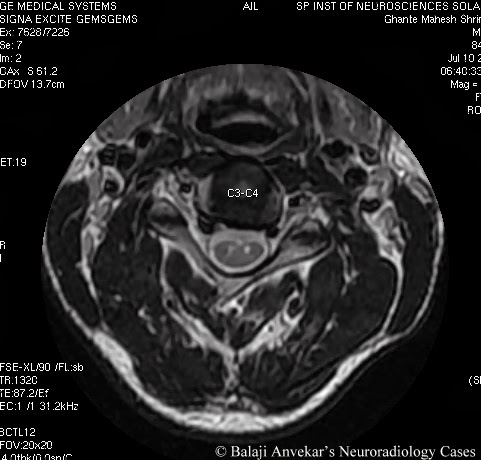 Dr Balaji Anvekar FRCR: DDs of Owl's Eye _ Spinal cord T2 hyper ...