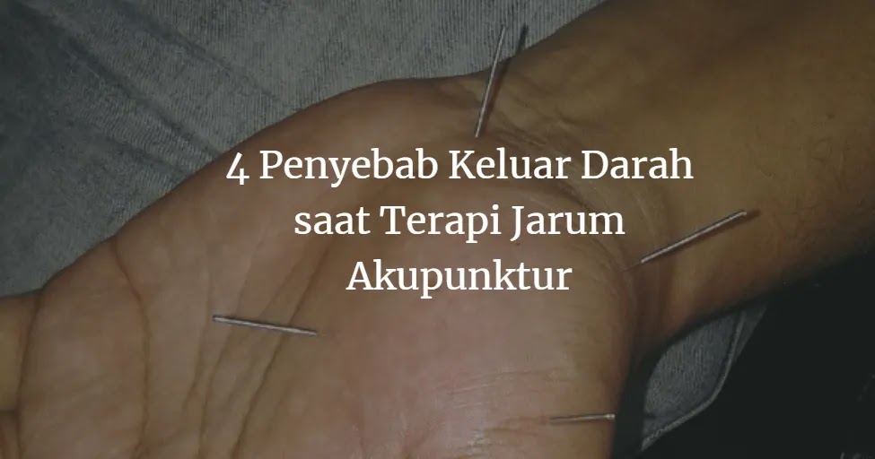 4 Penyebab Keluar Darah saat Terapi Jarum Akupunktur - Terapi Jarum