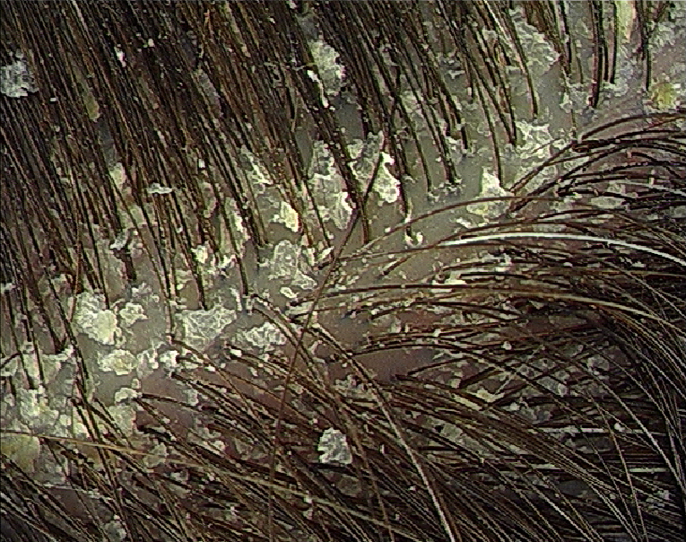 Dandruff and Your Diet Regime ~ All-INFORMATIONZ