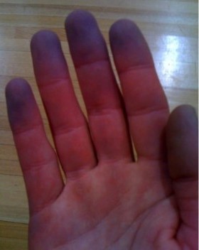 Dr. Amir's Blog: CREST Syndrome