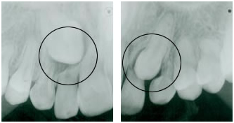 Dentistry and Medicine: ANOMALIES OF ERUPTION-THE ECTOPIC MAXILLARY CANINE