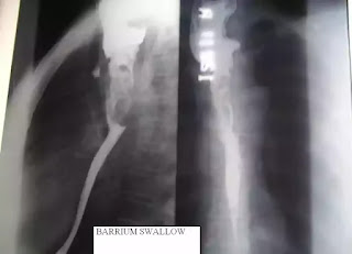 barium swallow - paramedical guru