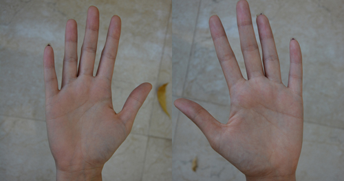 Forked Life Line | Split Life Line | Downward Branch From Life Line ...