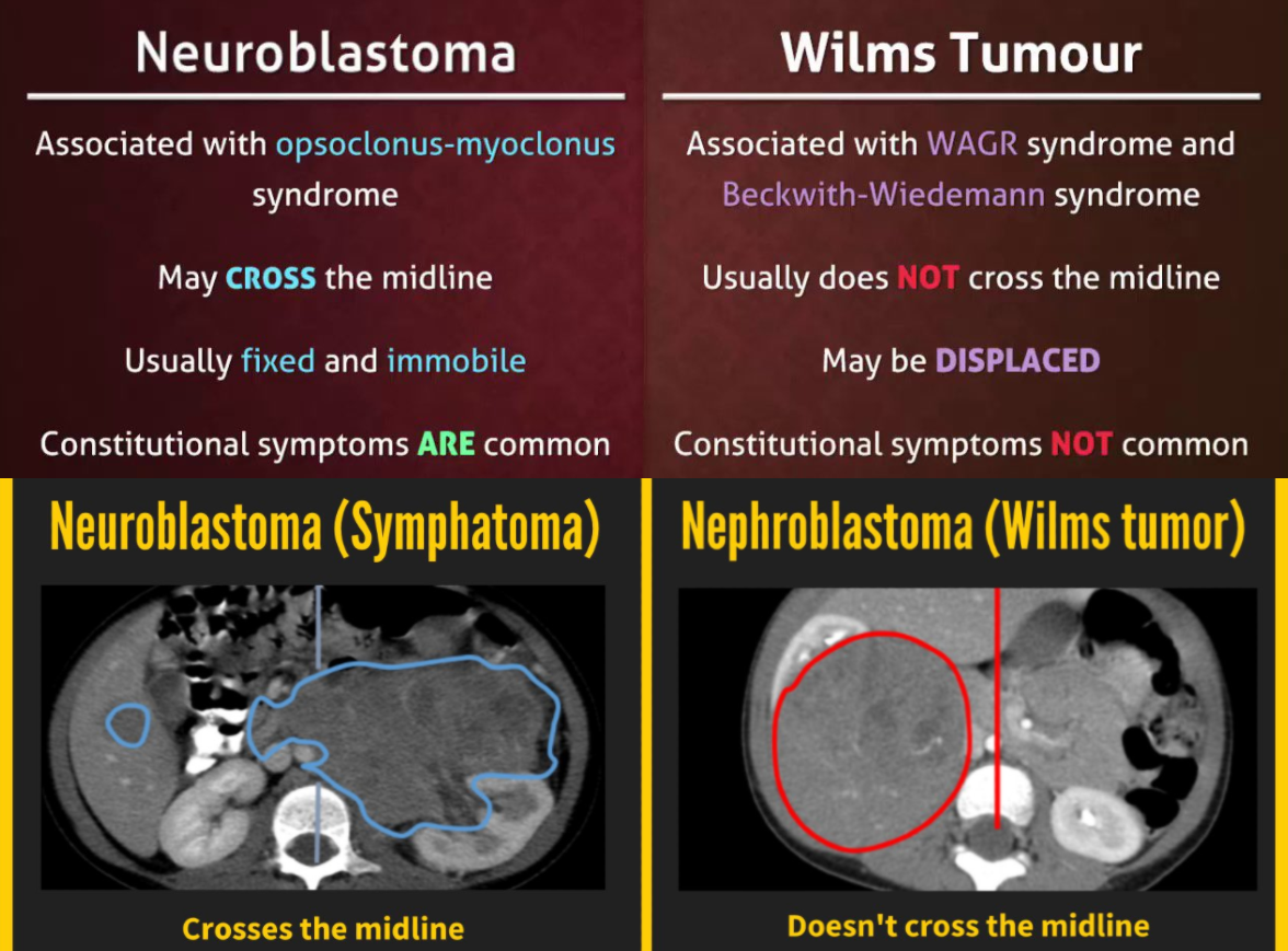 Neuroblastoma VS Wilms tumor (Nephroblastoma)