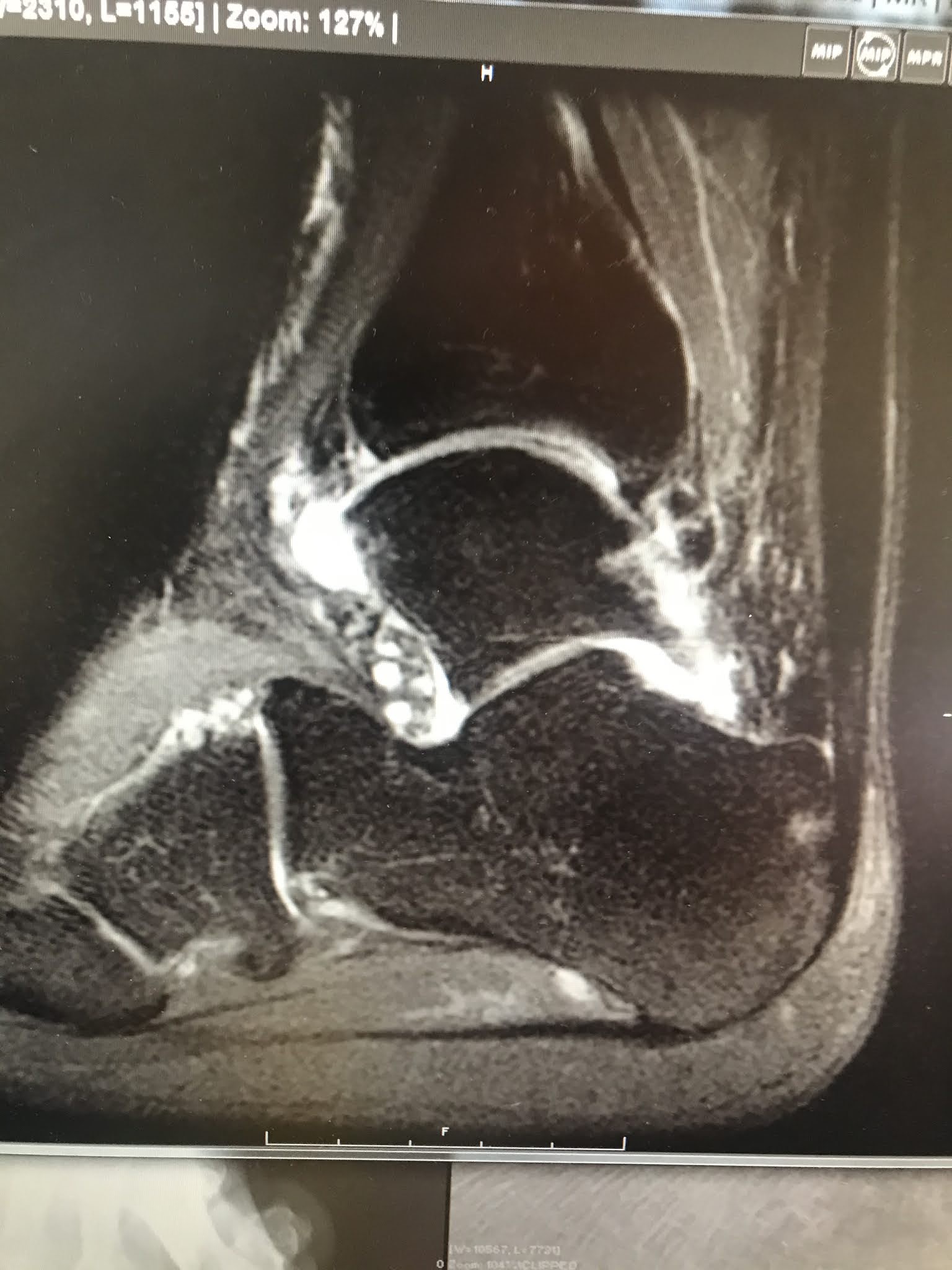 Plantar Fascia Mri Images Torn Yes Or No Bipmd