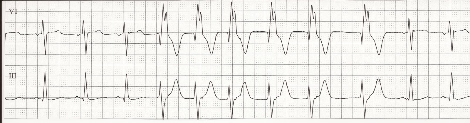 EKG Rhythm Strips 18: Ventricular Ectopy 1