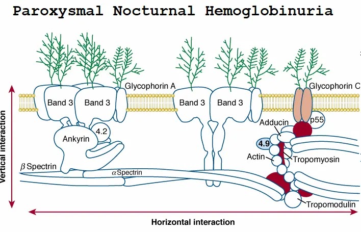 Paroxysmal Nocturnal Hemoglobinuria (PNH)