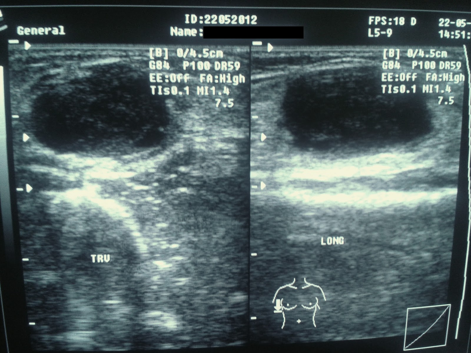 POINT OF VIEW: CASE 20: 12 y/o girl with left arm palpable mass