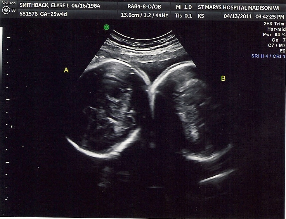 Smithback Twins: 26 Week Scan Pictures!