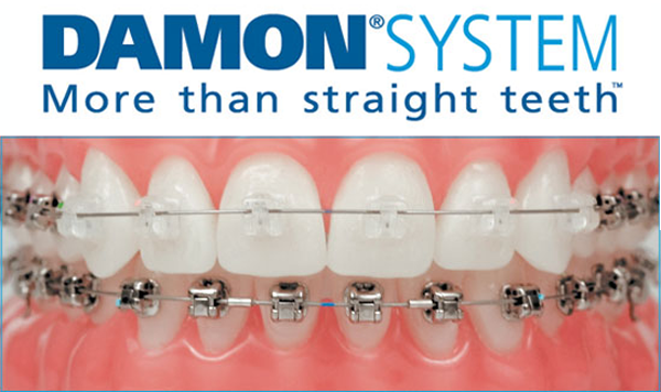 Morristown Orthodontics : The Damon System