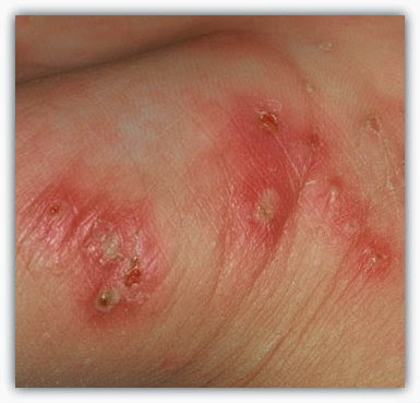 Ciri Ciri Orang Terkena Penyakit Kudis