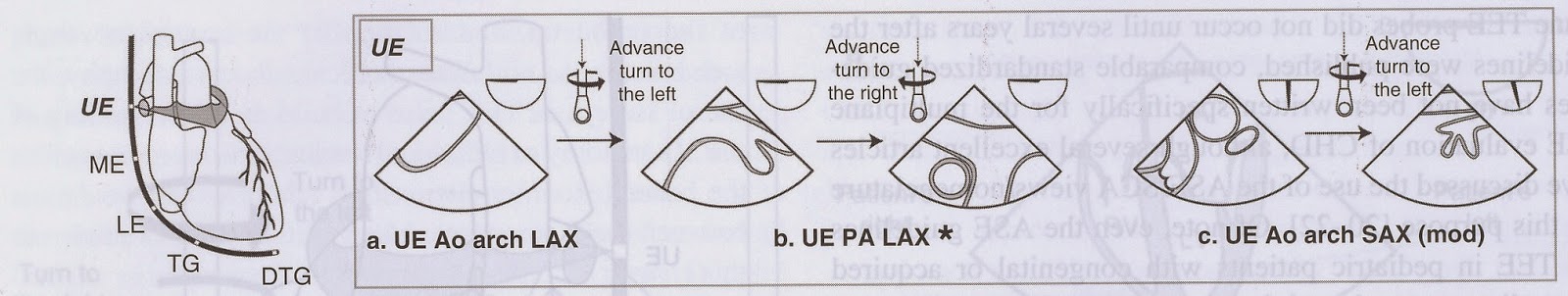 Pedi cardiology: TEE - Basic Views & terminology