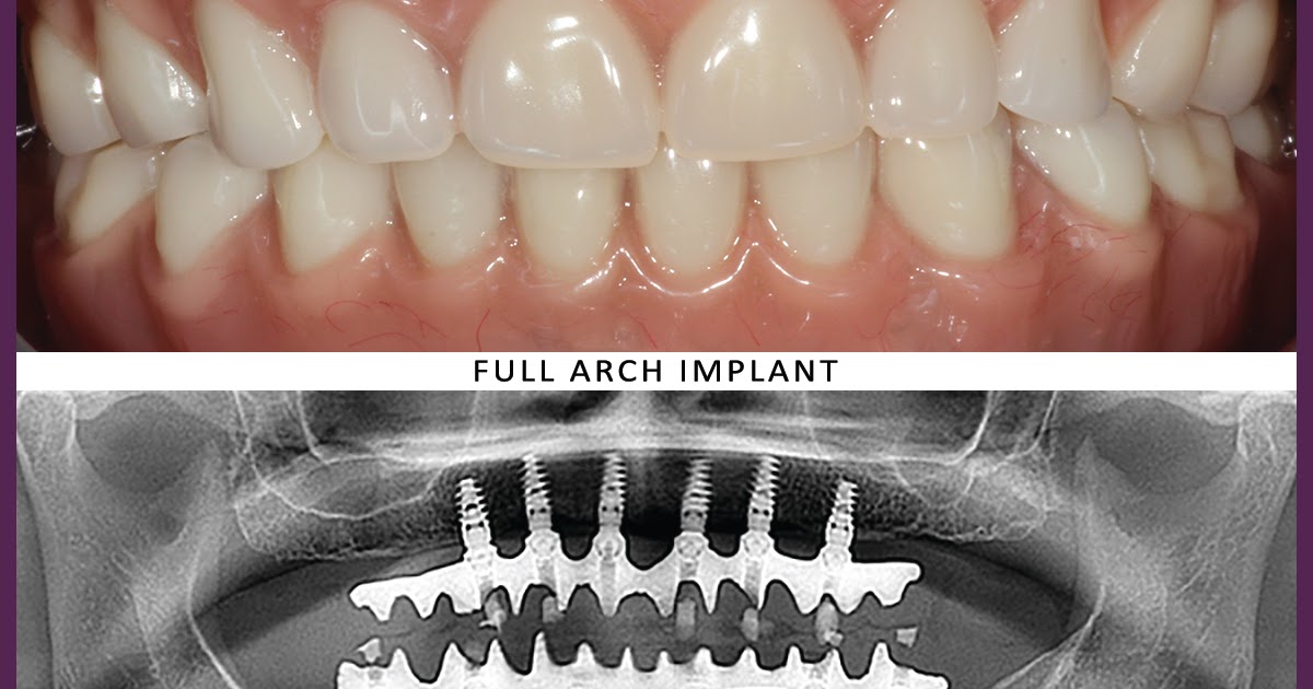 Ridgetop Dental: CT Scan And Implant Crown Planning-Things You Need To Know