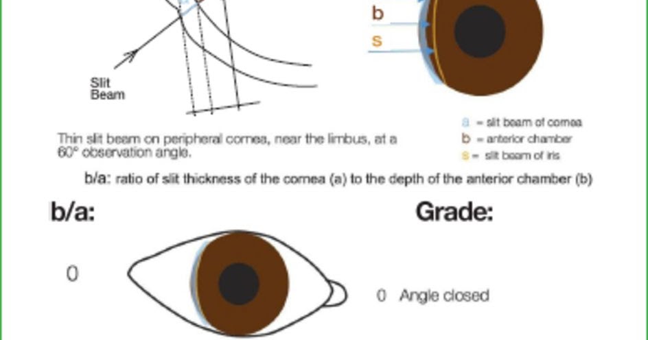 Ophthalmology Notes: Van Herick Method - AC Depth