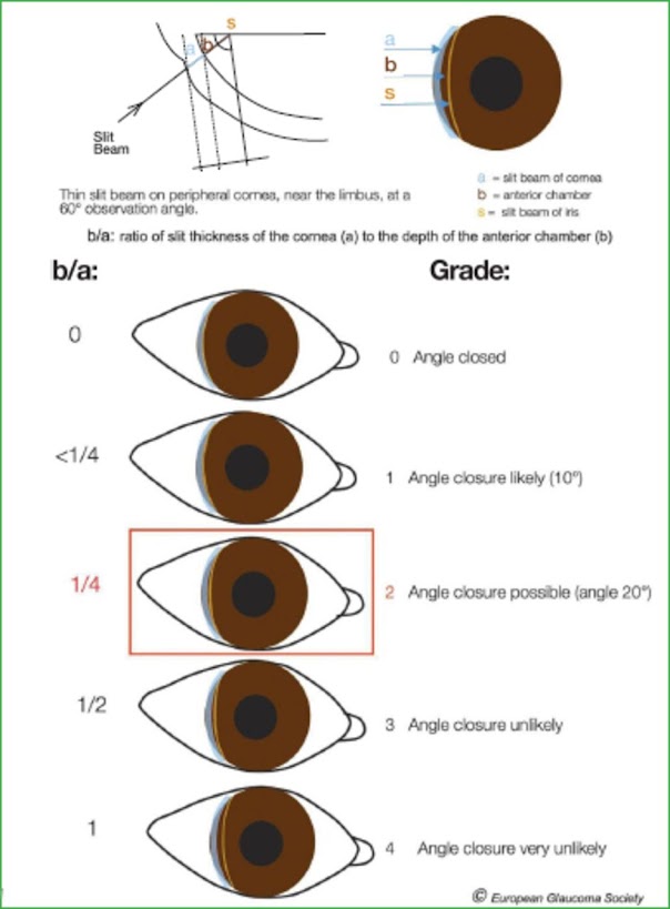 Ophthalmology Notes: Van Herick Method - AC Depth