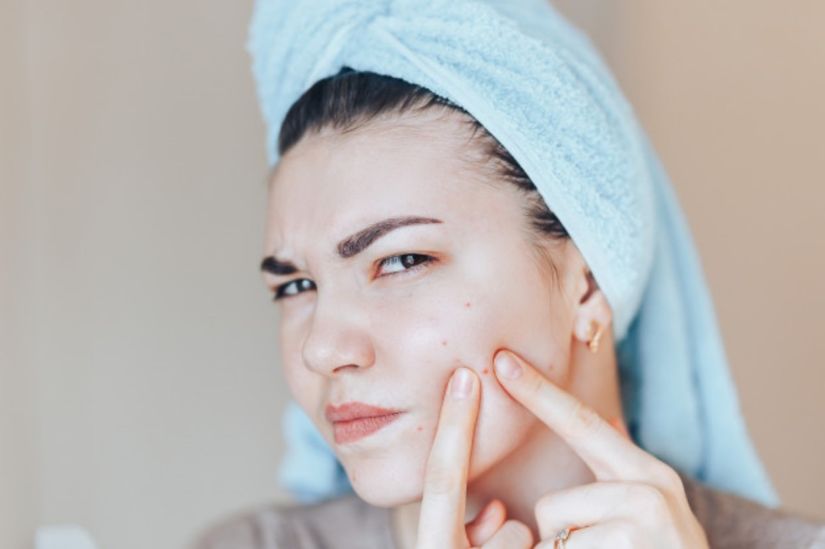 Remèdes maison pour se débarrasser de l'acné et des boutons