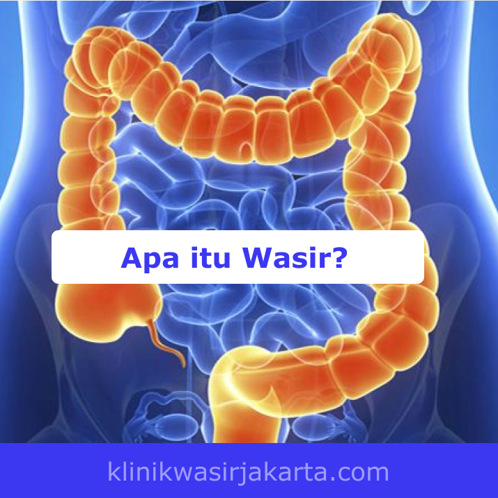 Apa itu Wasir? | Klinik Wasir Jakarta