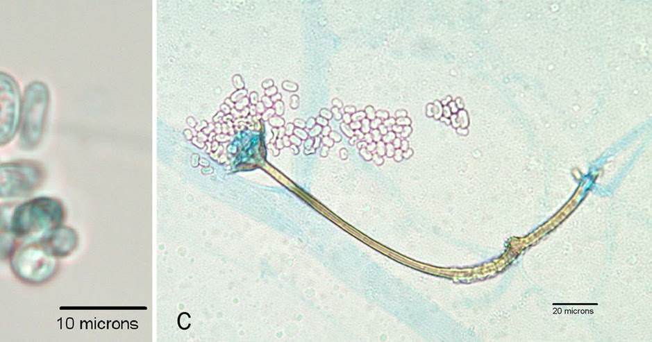 Fascitis necrotizante causada por Apophysomyces variabilis en un ...