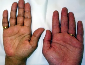 Medical Treatment Pictures-for Better Understanding: Addison’s Disease ...