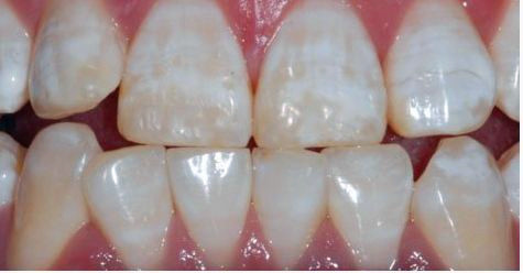 AKJ Dental Hospital Shenzhen : Fluorosis can be Removed with Scale ...