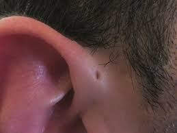 ~ The Foot Prints On Earth ~: ~Preauricular Ear Pit~