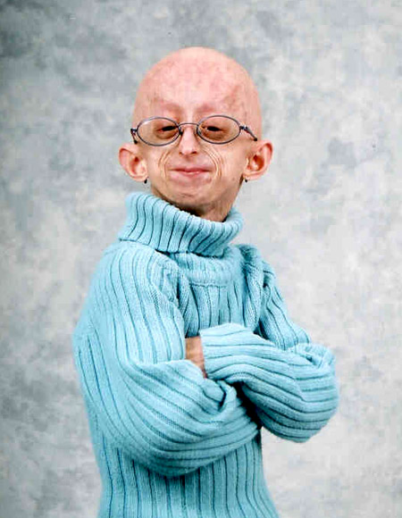 PATOLOGIAS EXTRAÑAS: Síndrome de progeria de Hutchinson-Gilford PATOLOGIAS EXTRAÑAS: Síndrome de progeria de Hutchinson-Gilford