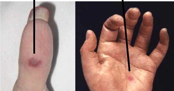 INFECTIVE ENDOCARDITIS (IE)