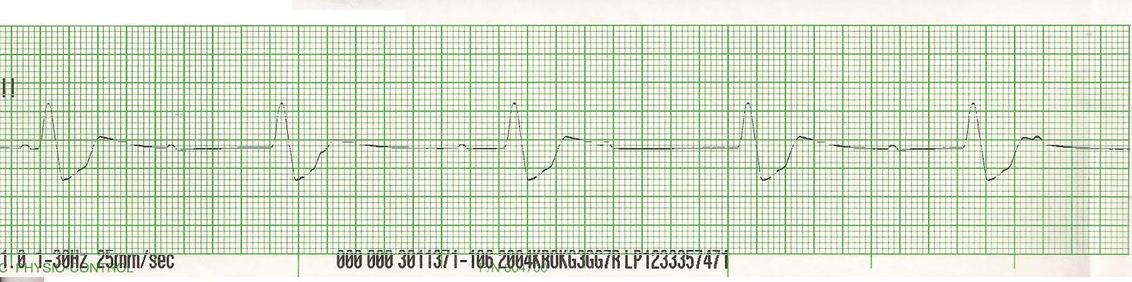Pediatric External Pacing
